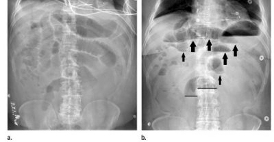 Bridas e a radiografia abdominal: tudo que você deve saber - Medway