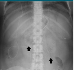 Bridas e a radiografia abdominal: tudo que você deve saber - Medway