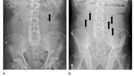 Bridas e a radiografia abdominal: tudo que você deve saber - Medway