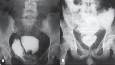 Lesão traumática de bexiga: saiba mais! - Medway