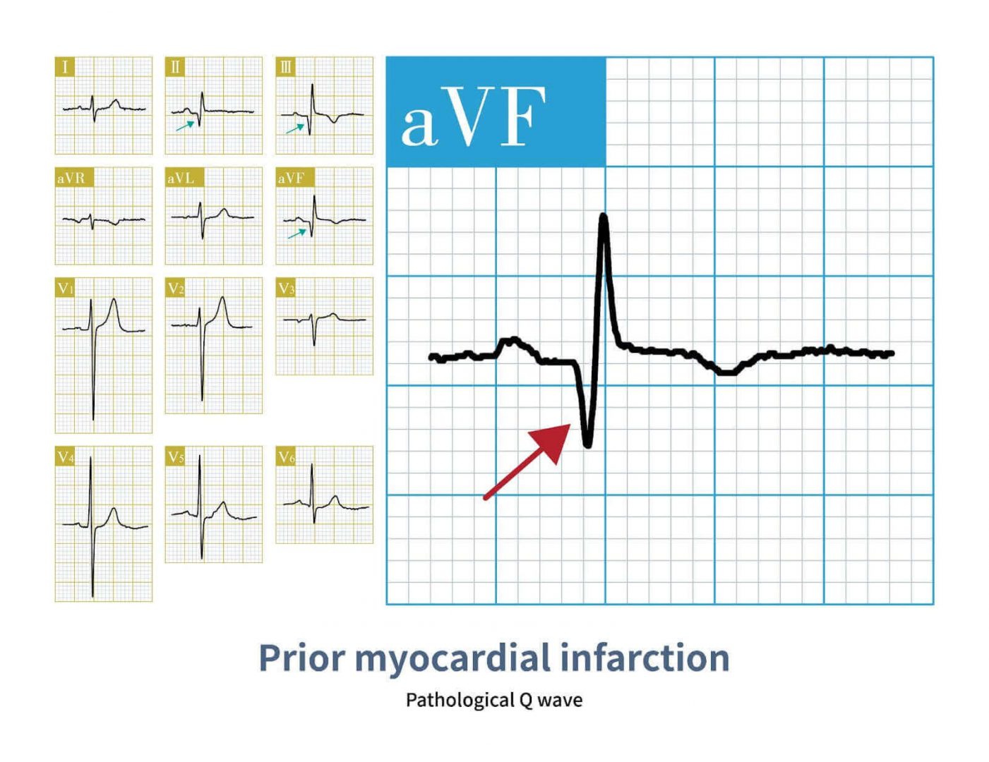 Onda Q patológica: como reconhecer no eletrocardiograma - Medway